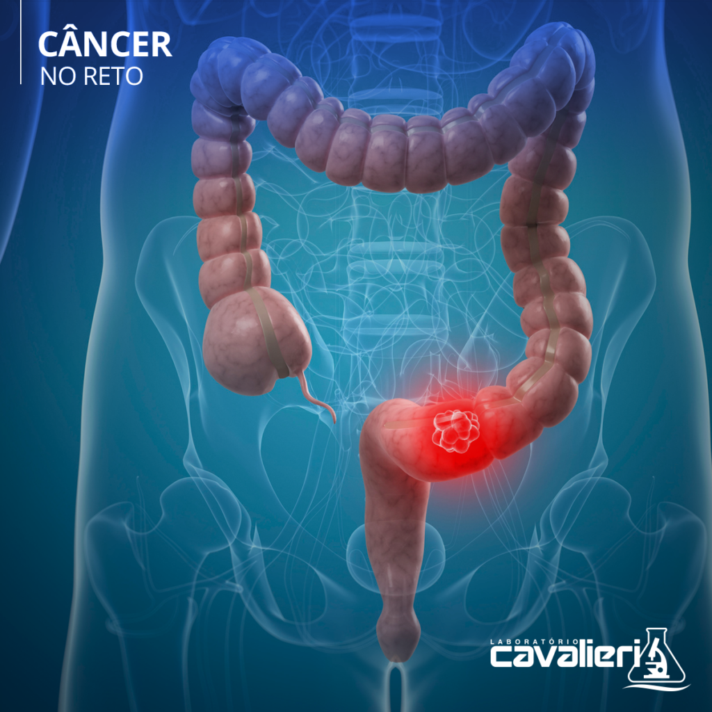 Laboratório Cavalieri Câncer no Reto - Laboratório Cavalieri
