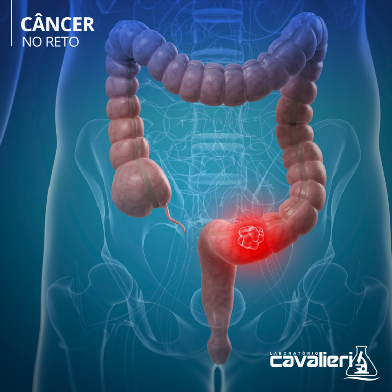Laboratório Cavalieri Câncer no Reto - Laboratório Cavalieri